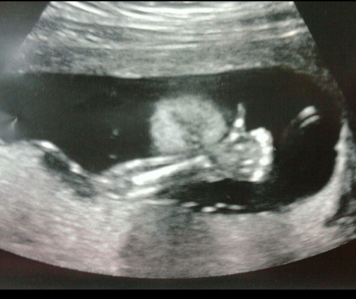 Thumbs up on life for Gambrills family - Catholic Review